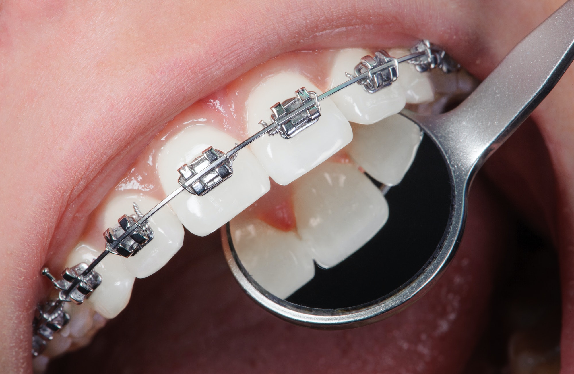 Ortodonzia: che cos’è nel dettaglio? - Dentista Emanuela Raffoni